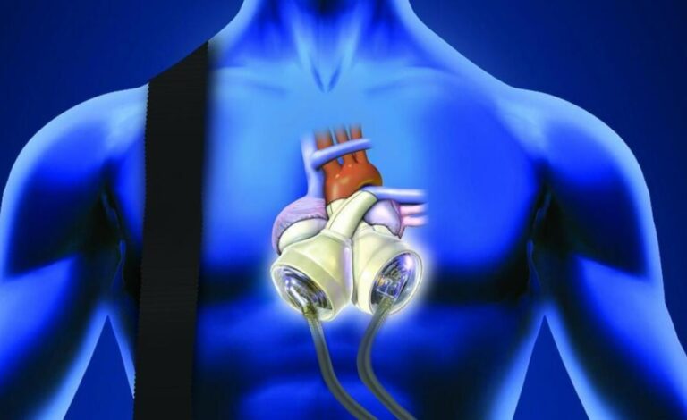 Total artificial heart (TAH) or bionic heart - Pros and cons - RoboticsBiz